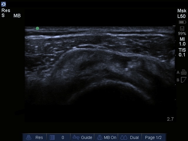 Shoulder Torn Rotator Cuff Transverse Image | Sonosite Institute for ...